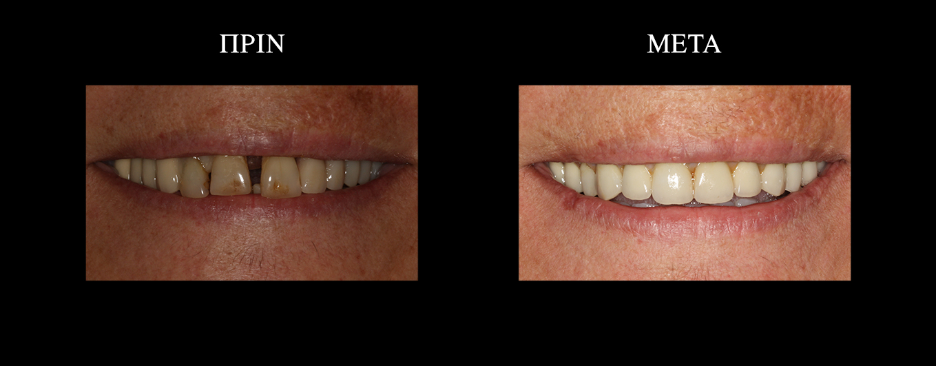 ΕΜΦΥΤΕΥΜΑΤΑ – Λευκάδα – Περιοδοντολογικό Ιατρείο, Εμφυτεύματα ...